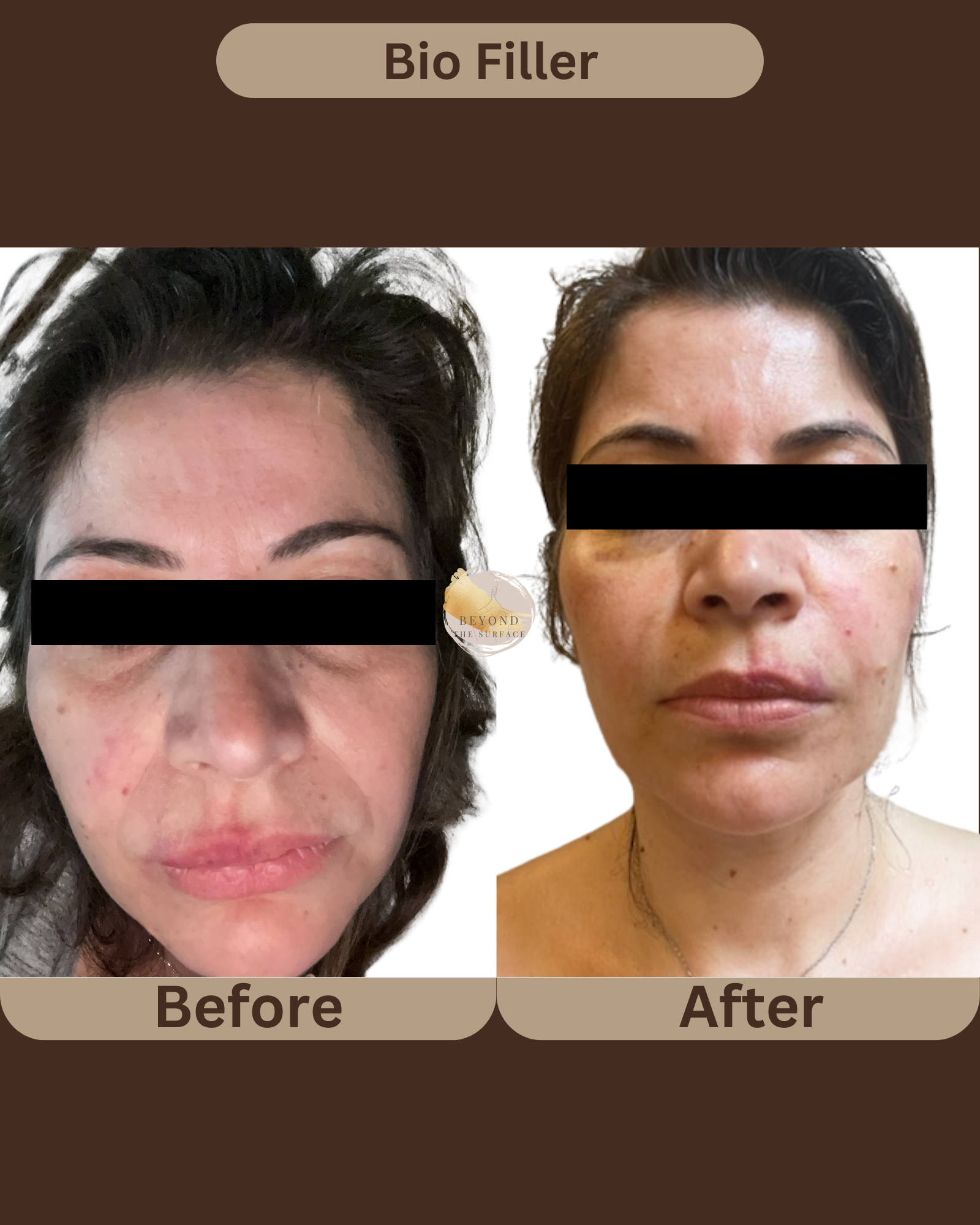 Transformative Power of Bio-Filler - BTS