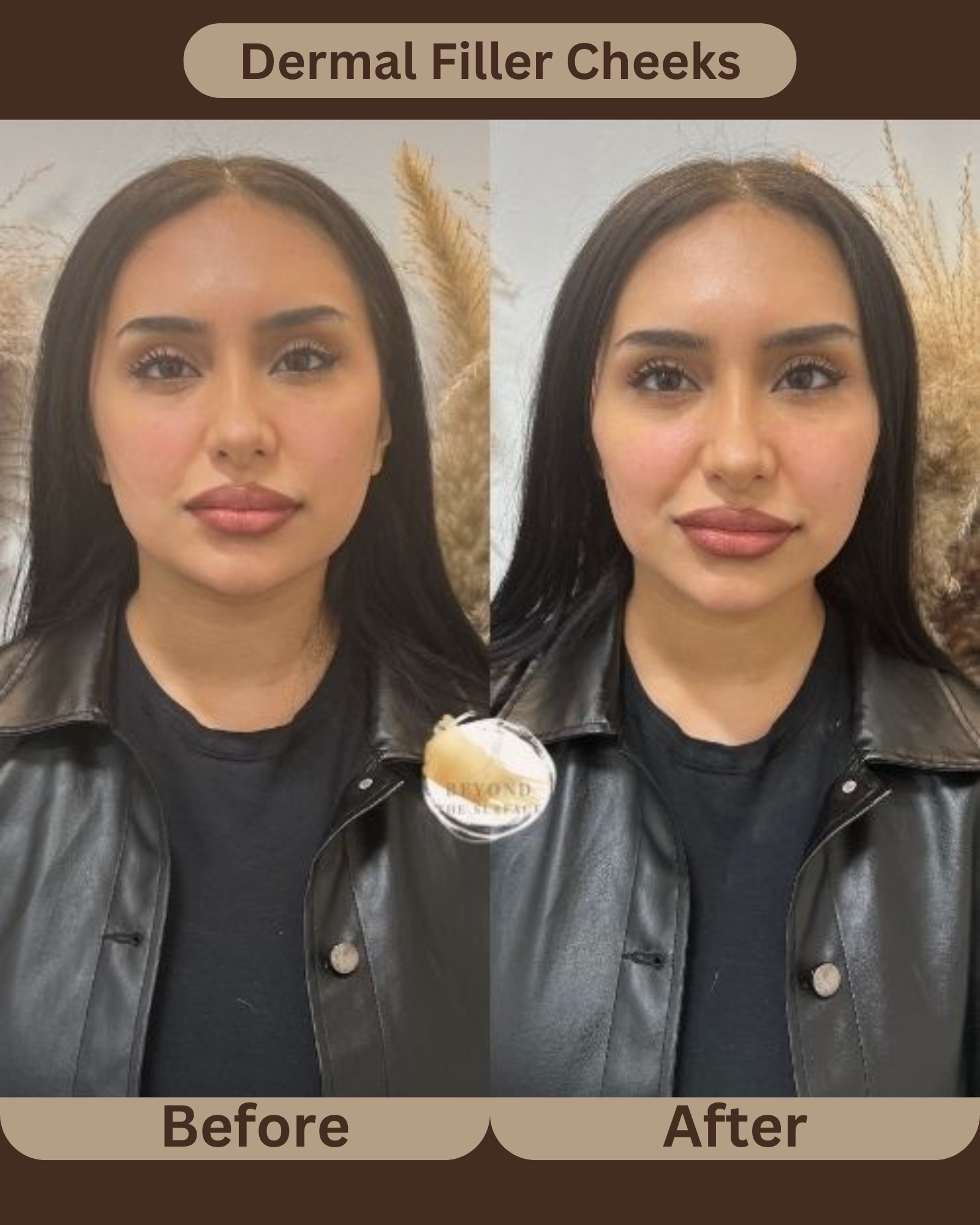 Unlock the Age-Defying Power of Dermal Fillers at Beyond The Surface ...